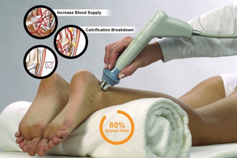 Shock Wave Therapy – BackOnTrackHealthcare